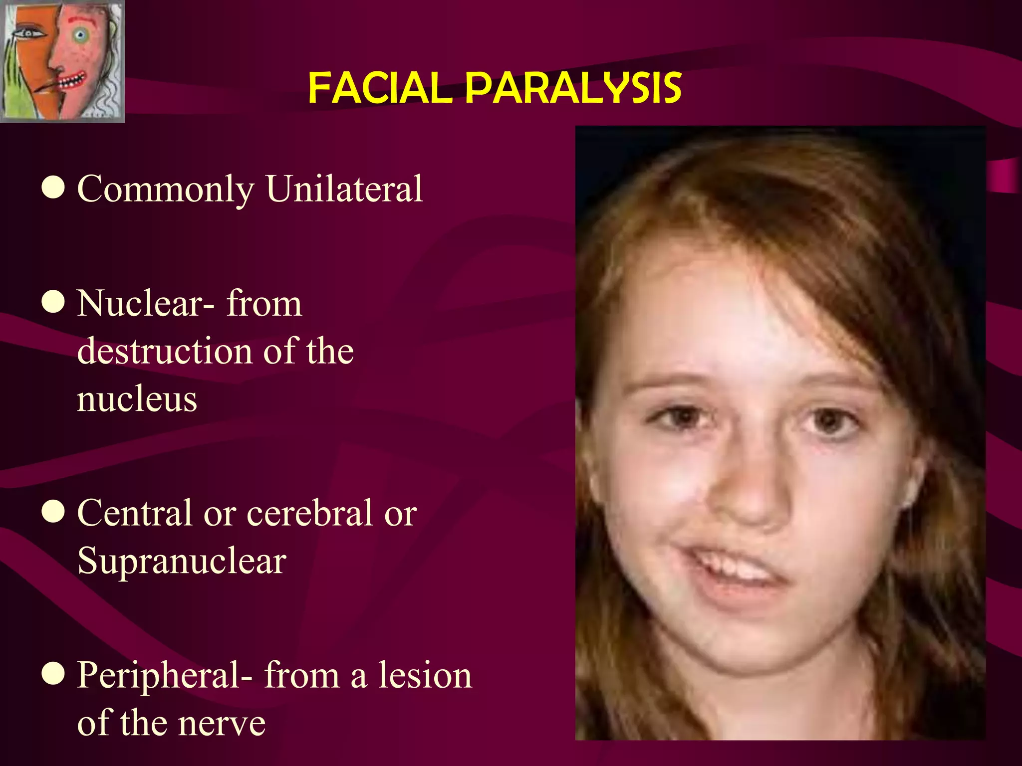 Facial palsy | PPTX