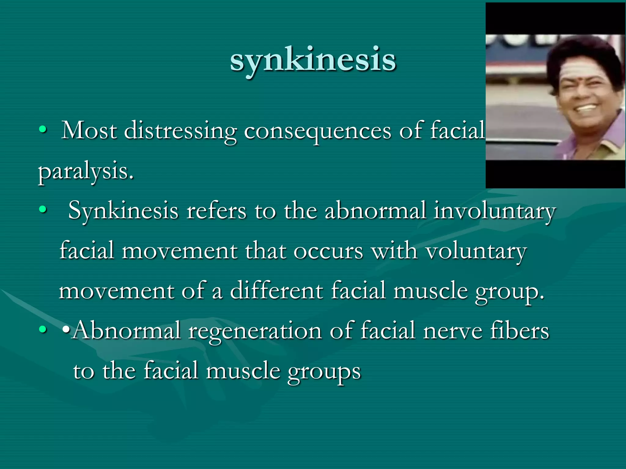 Facial palsy | PPTX