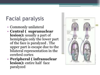 Facial palsy | PPTX