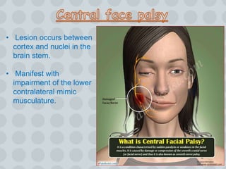 Facial palsy | PPTX