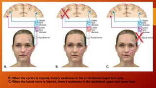 Facial paralysis | PPT