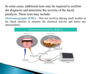 Facial Paralysis PPT.pptx