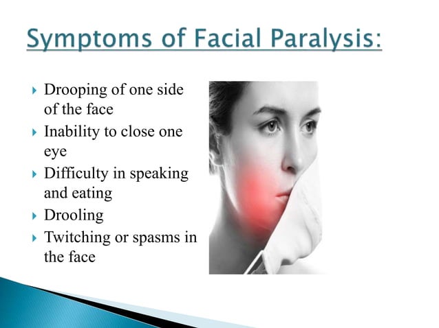 Facial Paralysis PPT.pptx