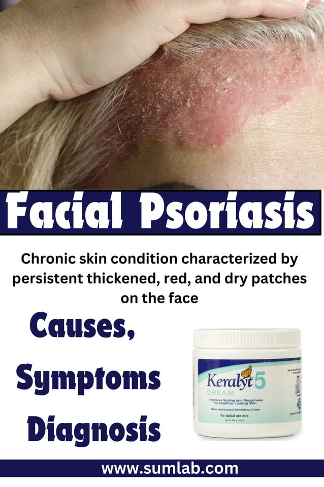 What are the treatment options for facial psoriasis? | PDF