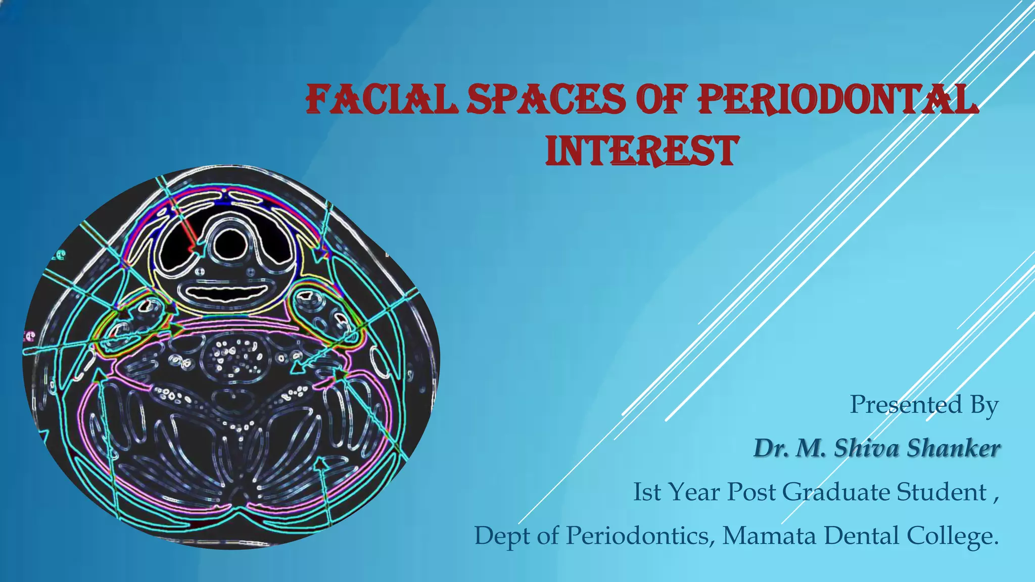 Facial spaces of periodontal interest. | PPTX