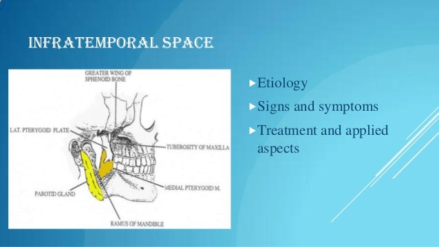 Pterygomandibular Space Infection