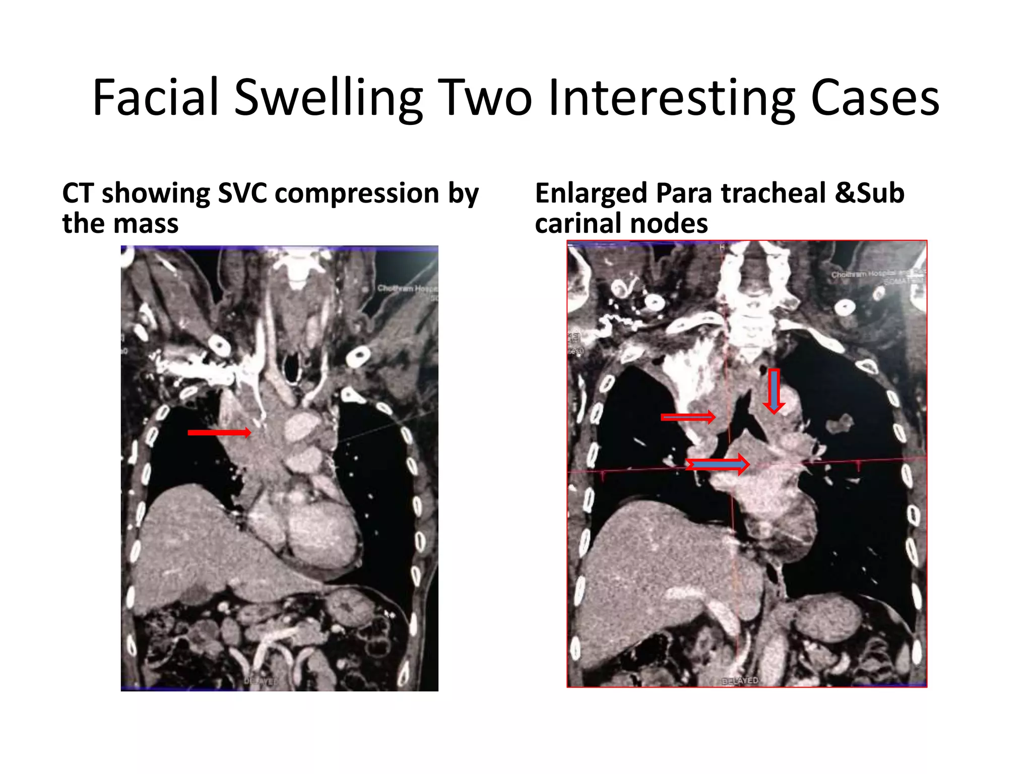 Facial swelling unusual cause | PPTX