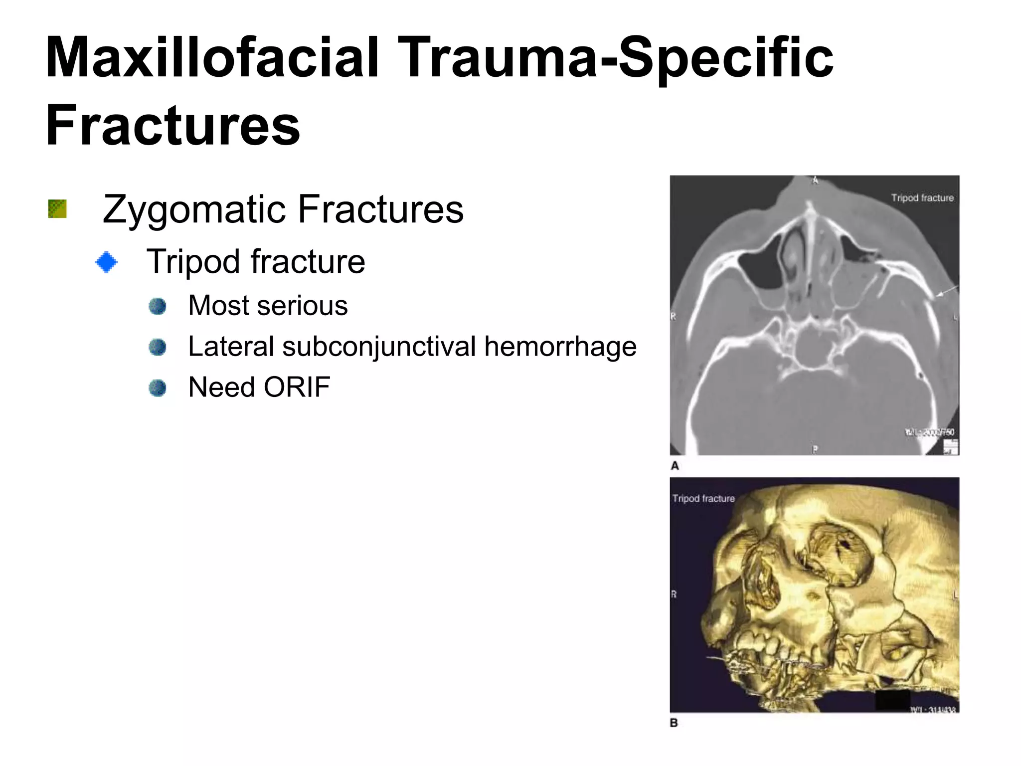 Facial Trauma | PPTX