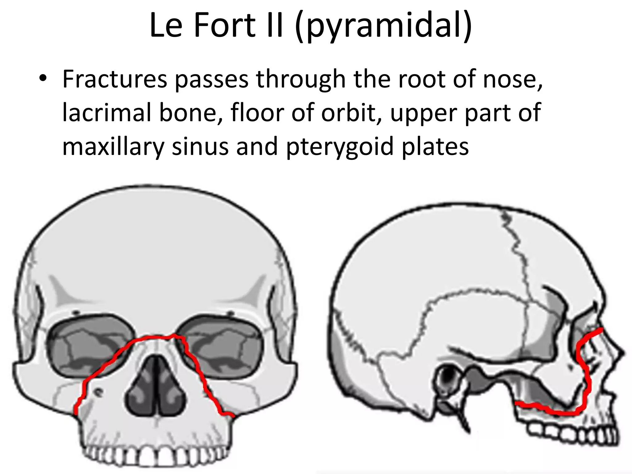 Facial trauma | PPTX