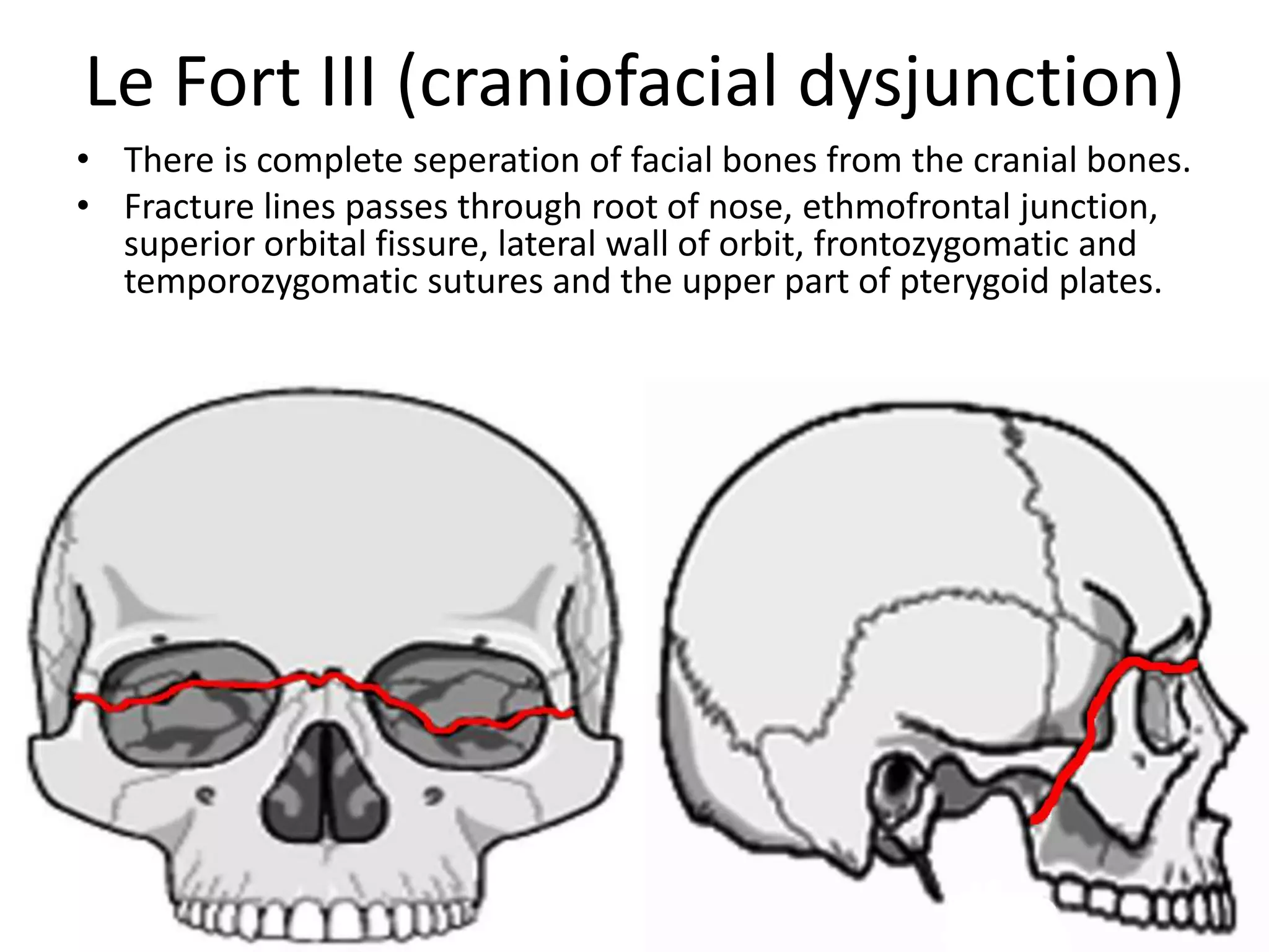 Facial trauma | PPTX