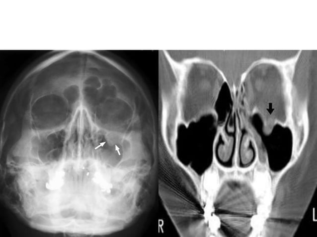 Facial trauma | PPTX