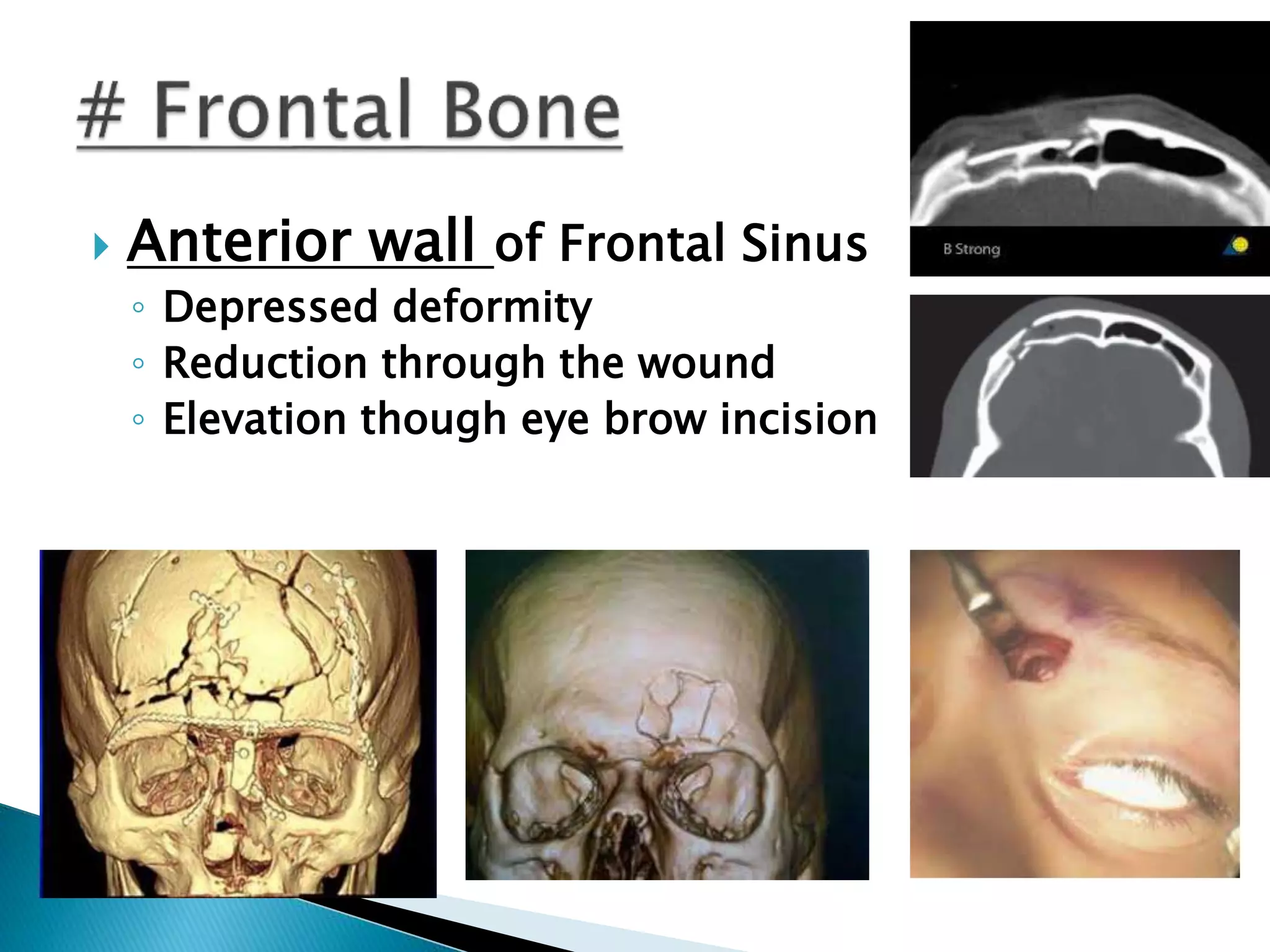 Facial trauma and oroantral fistula | PPT