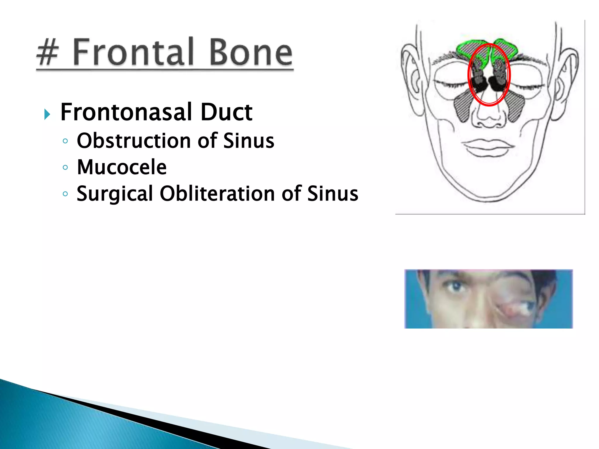 Facial trauma and oroantral fistula | PPTX