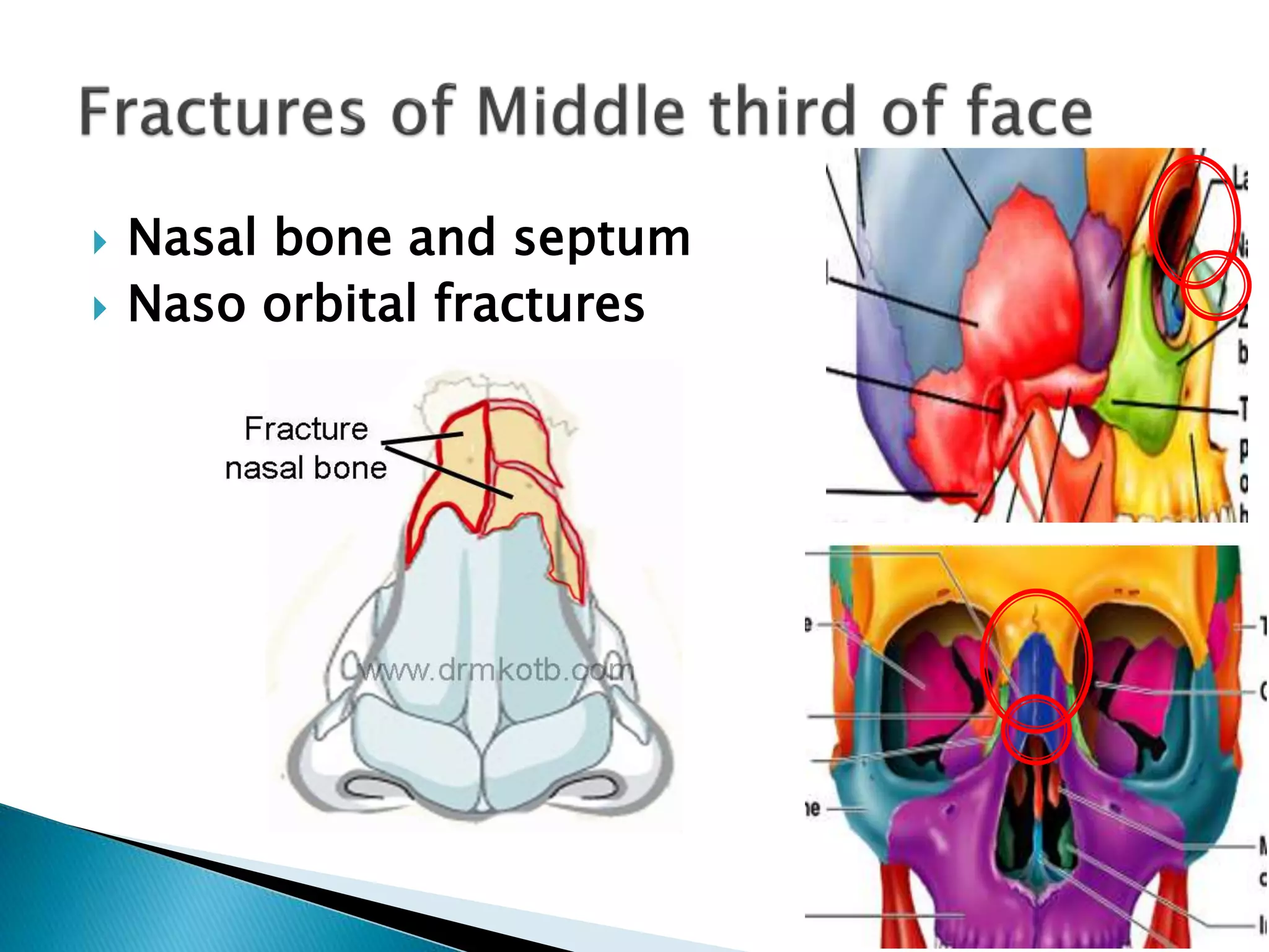 Facial trauma and oroantral fistula | PPTX