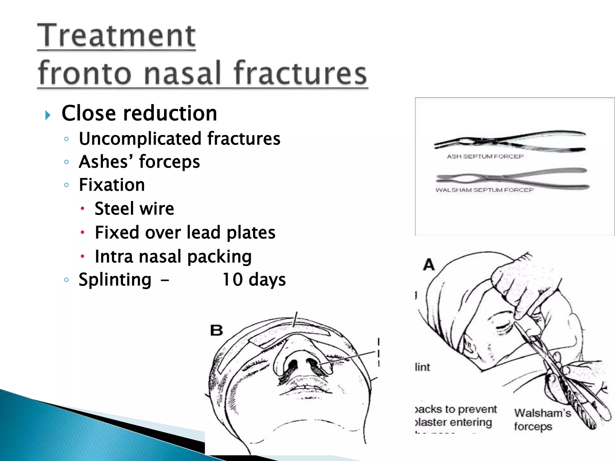 Facial trauma and oroantral fistula | PPTX