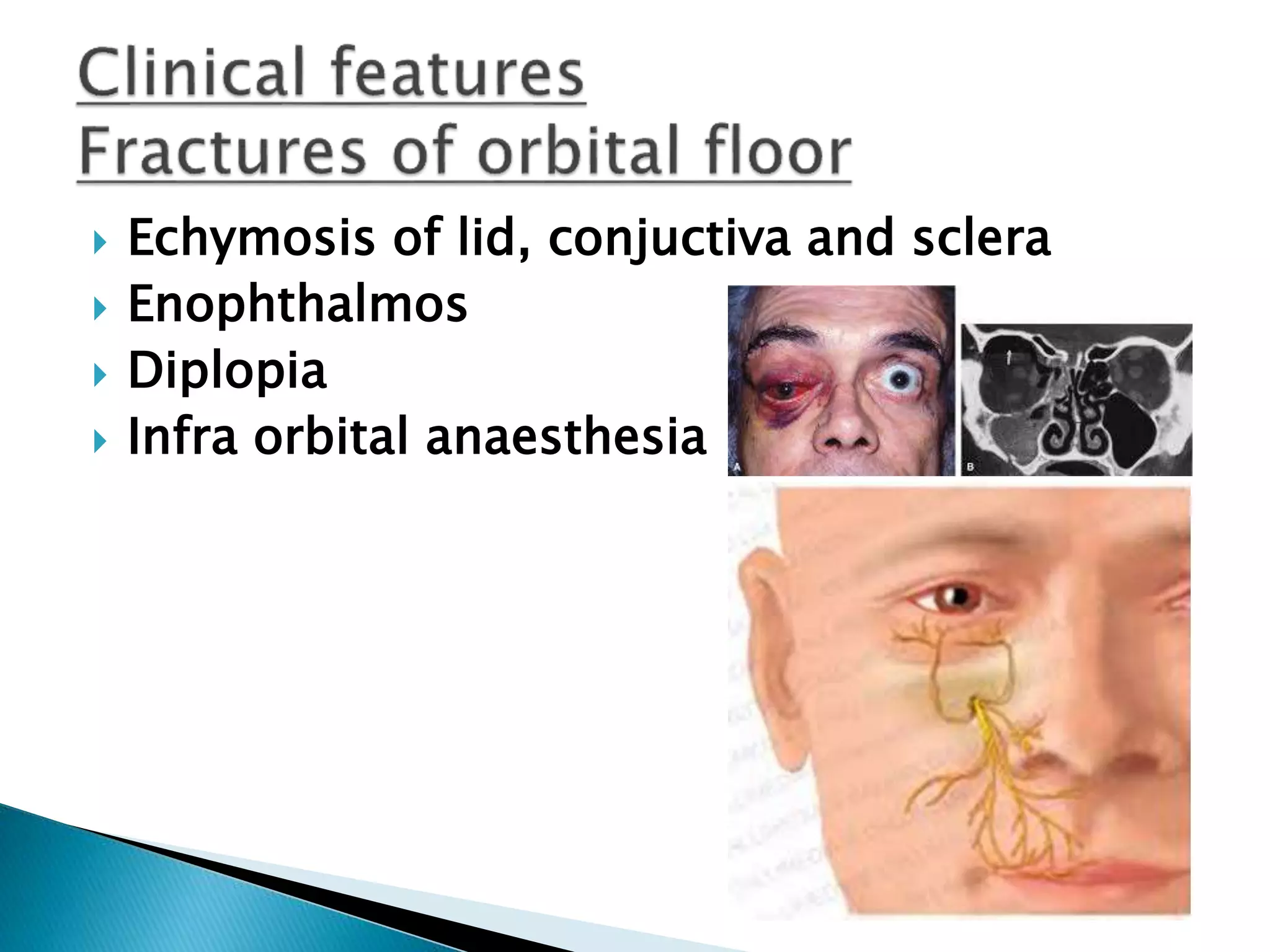 Facial trauma and oroantral fistula | PPTX
