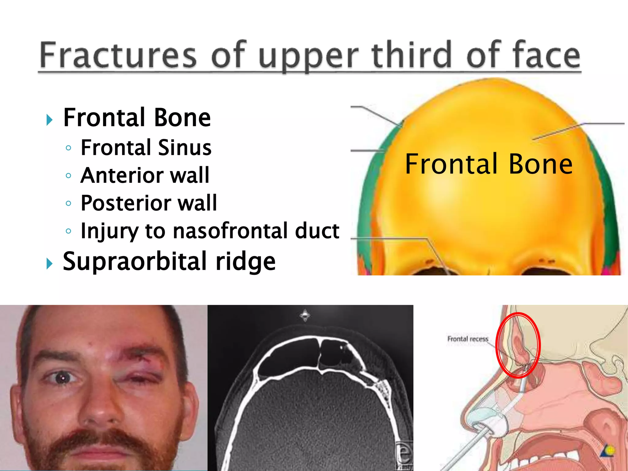 Facial trauma and oroantral fistula | PPTX