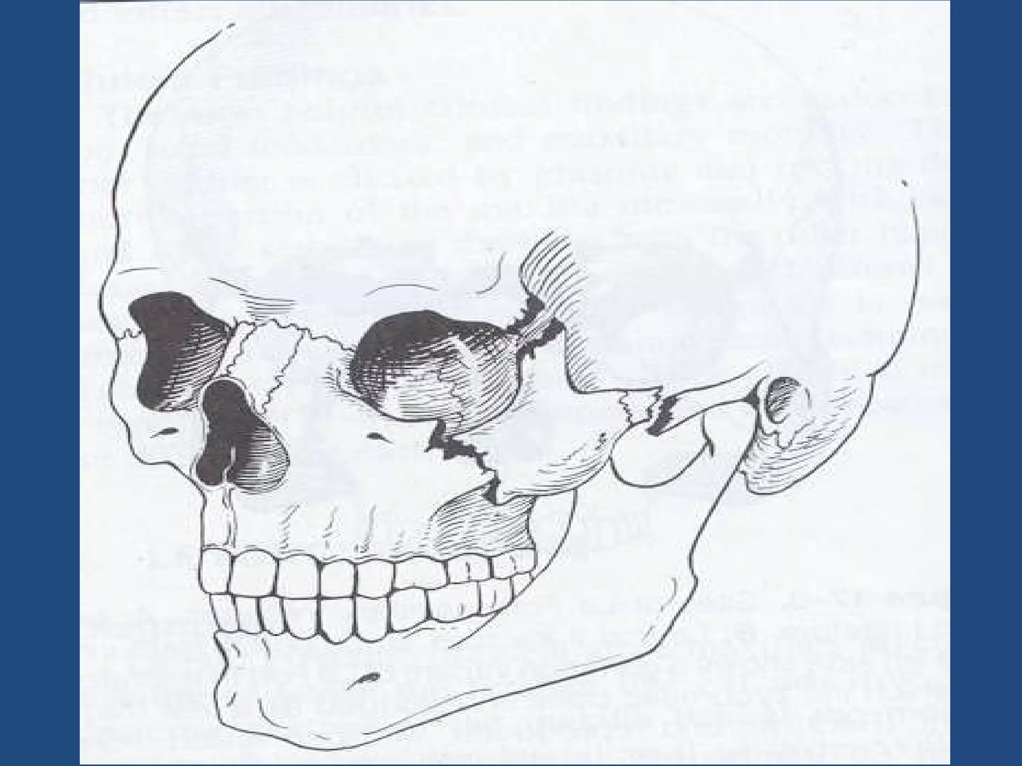 Facial trauma and neck trauma | PPT