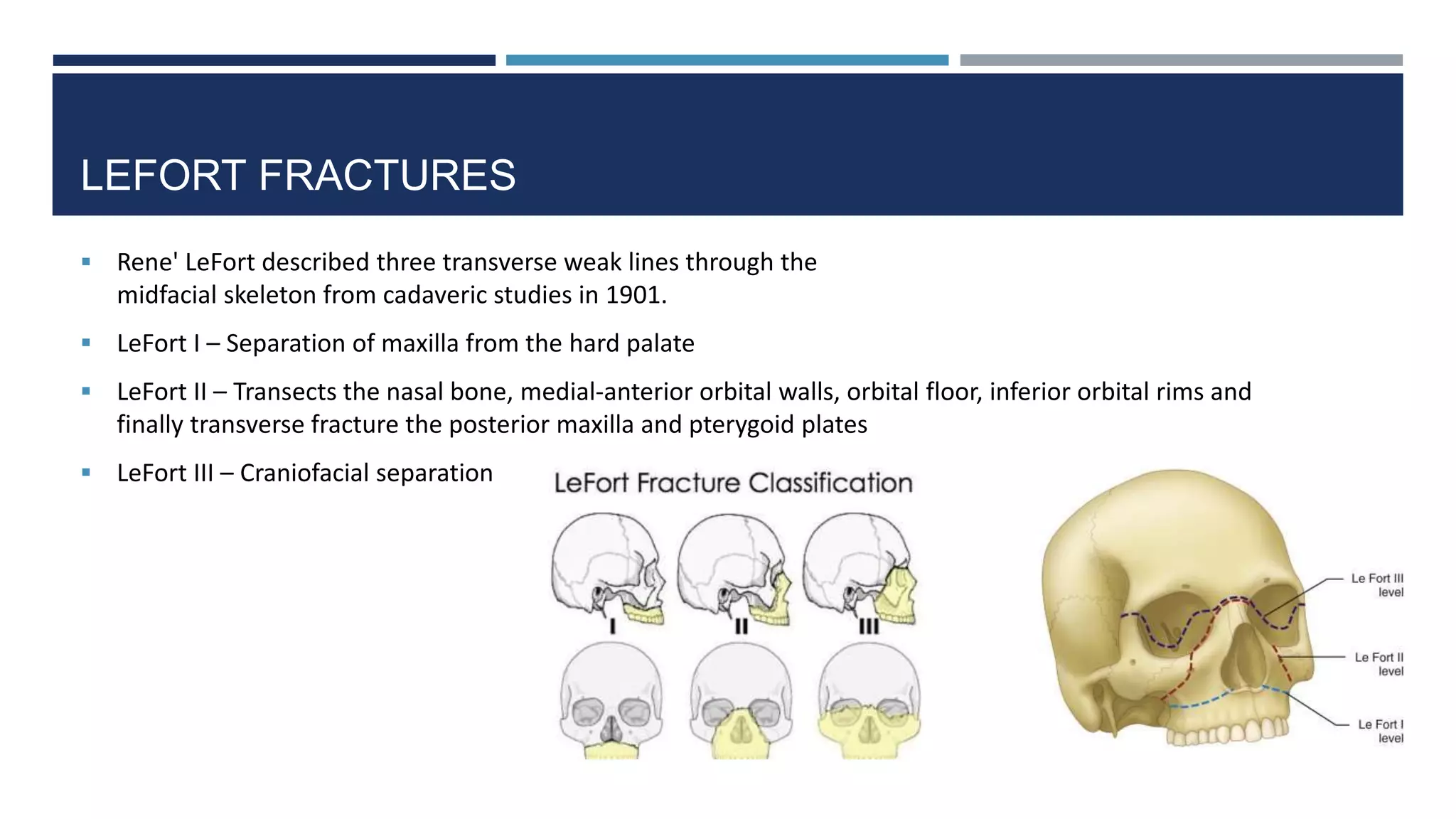 Nasal Bone Fractures.pptx