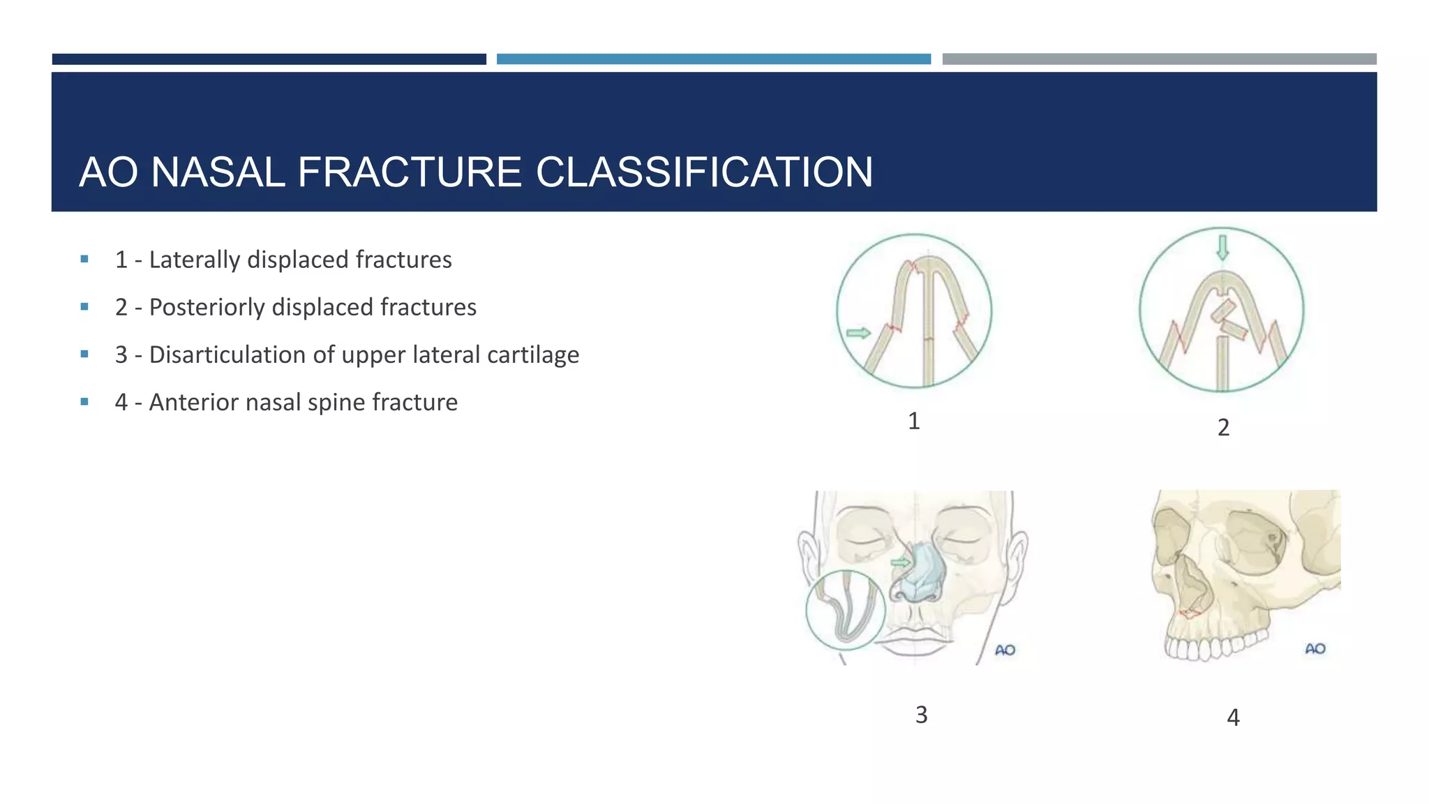 Nasal Bone Fractures.pptx