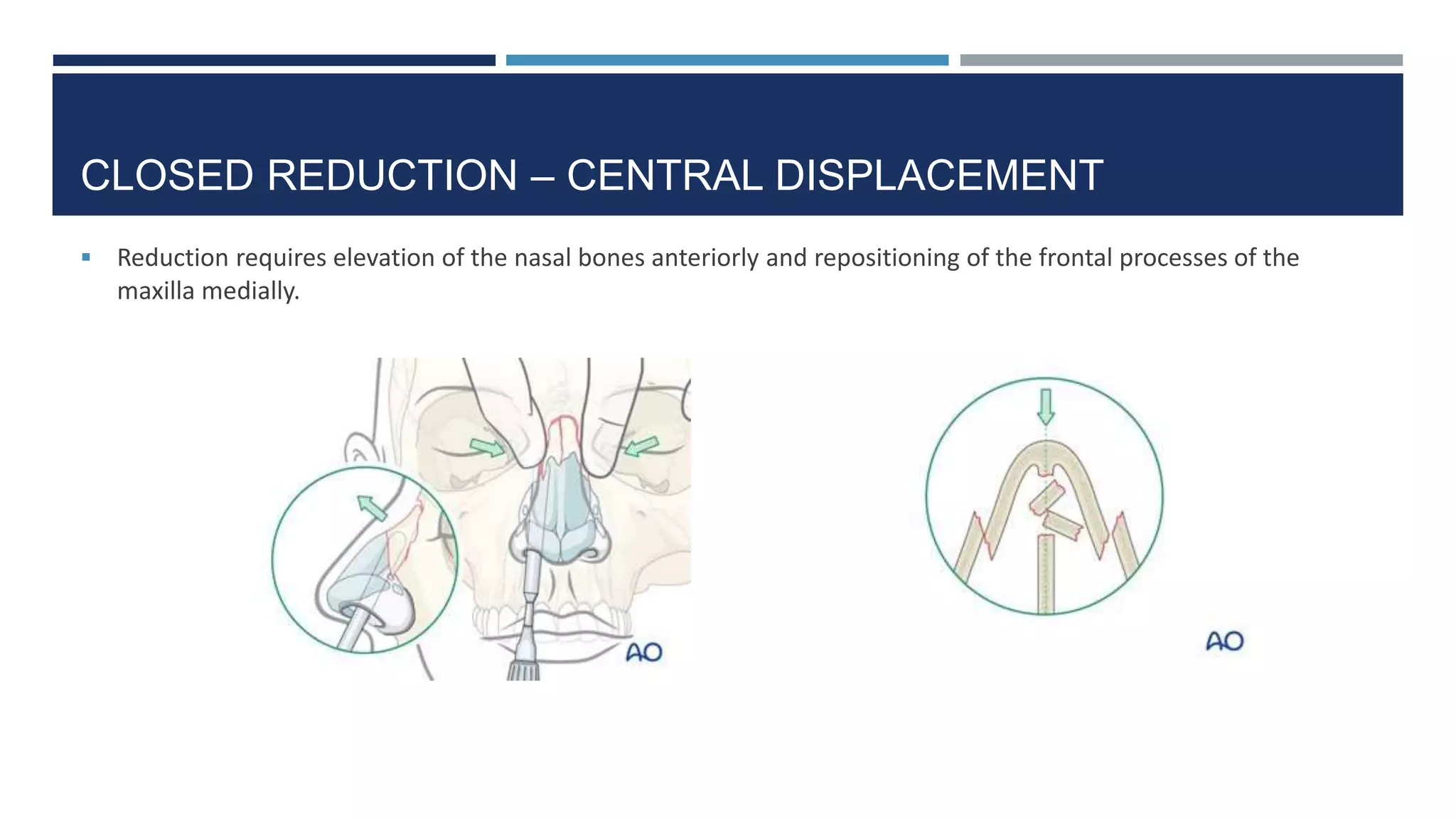 Nasal Bone Fractures.pptx