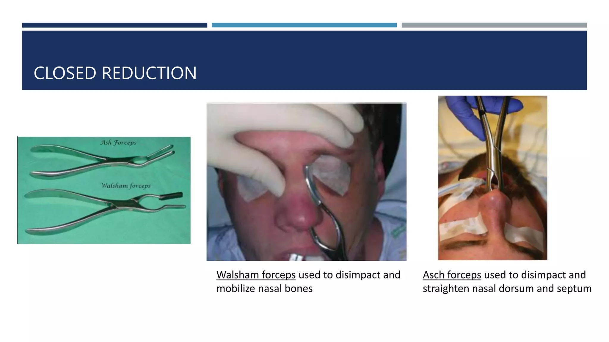 Nasal Bone Fractures.pptx