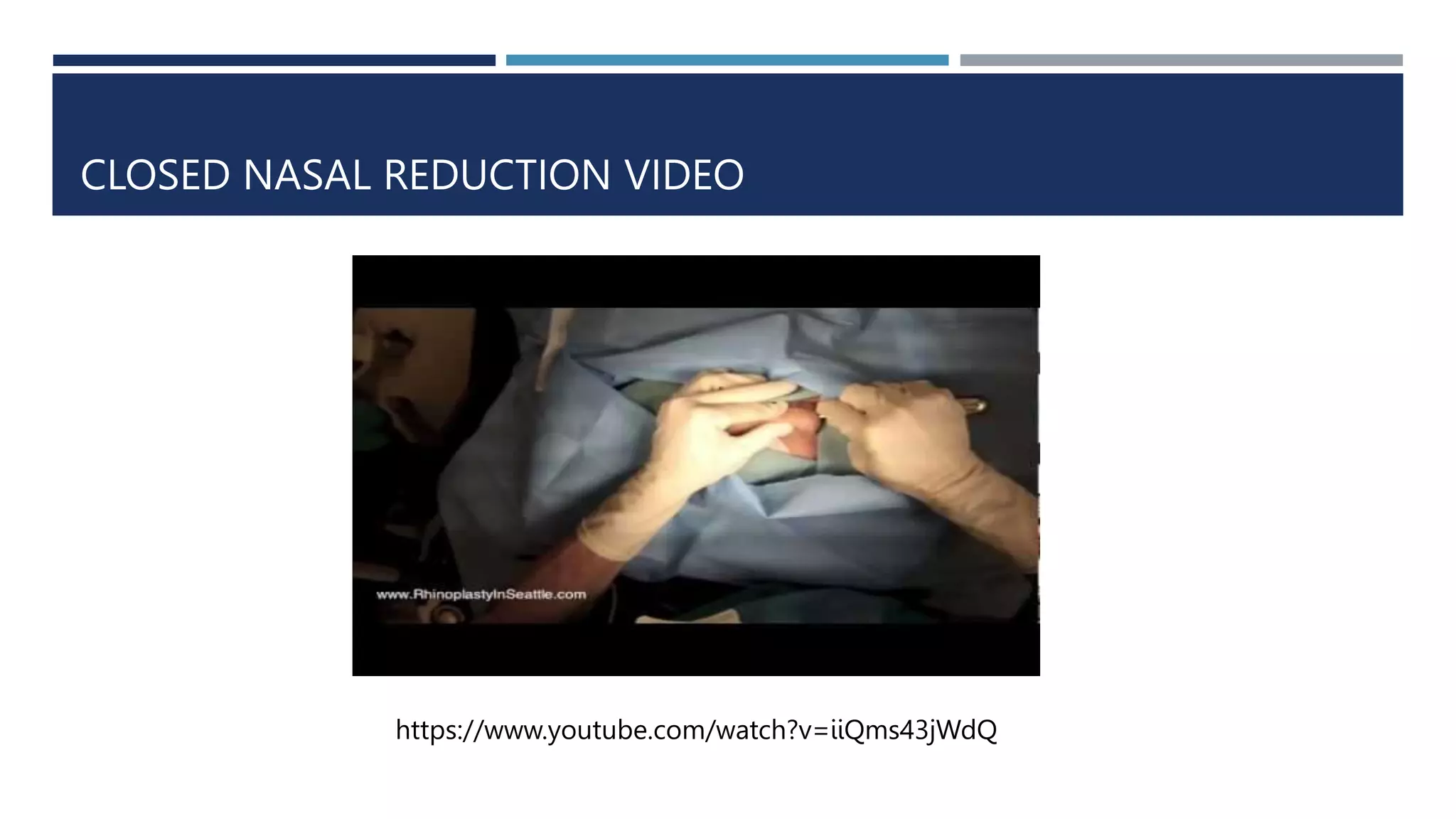 Nasal Bone Fractures.pptx