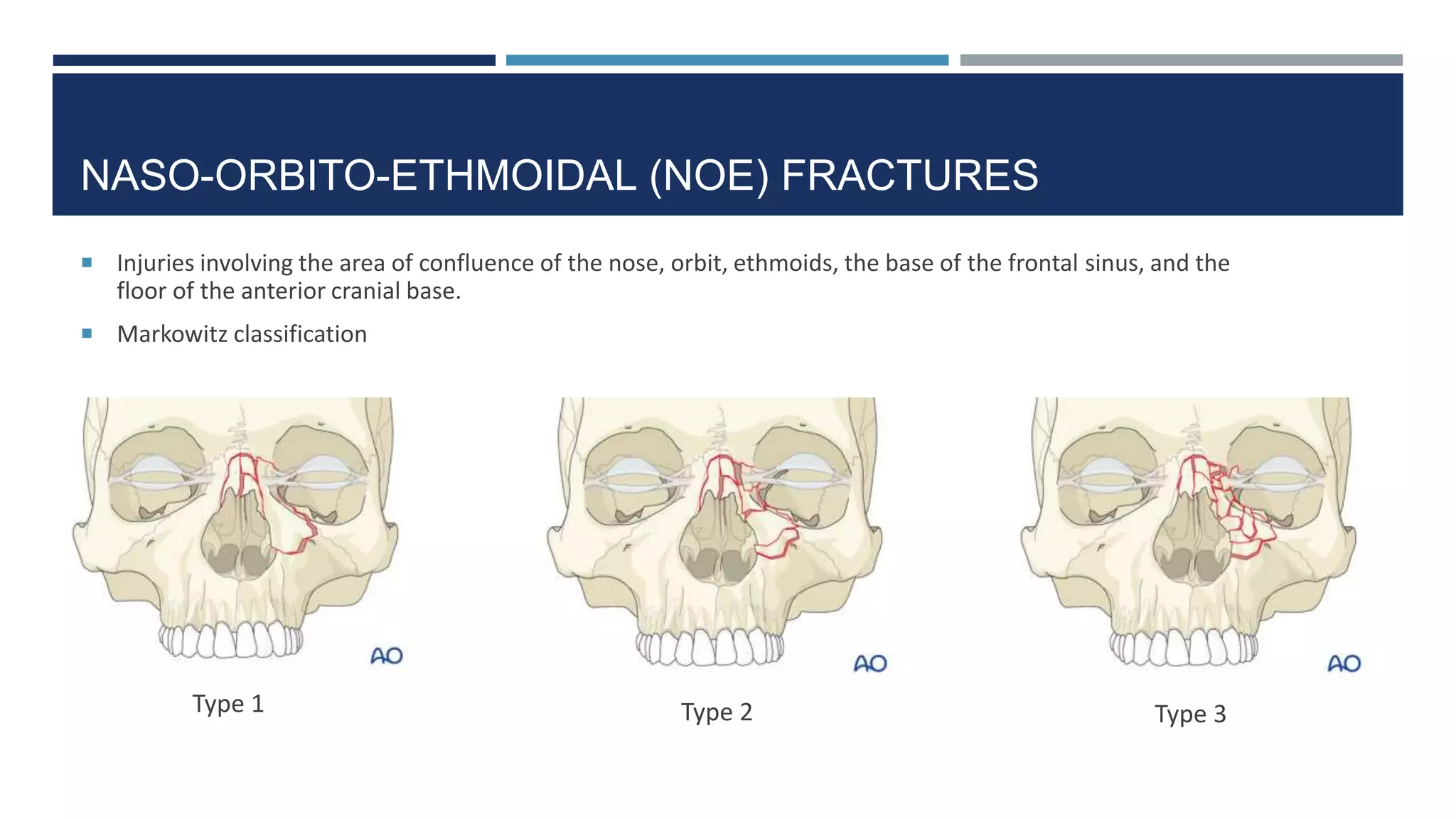 Nasal Bone Fractures.pptx