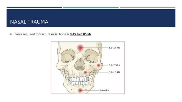 Nasal Bone Fractures.pptx