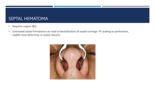 Nasal Bone Fractures.pptx