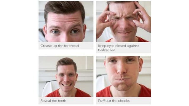 Facial weakness.pptx | Ear, Nose and Throat Conditions | Diseases and ...