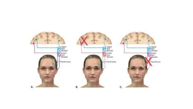 Facial weakness.pptx | Ear, Nose and Throat Conditions | Diseases and ...