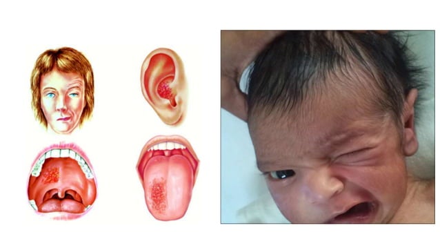 Facial weakness.pptx | Ear, Nose and Throat Conditions | Diseases and ...