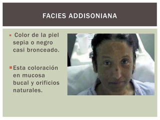 Facies Parkinsoniana