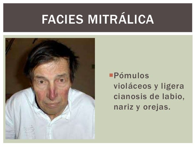 Facies Mitralis