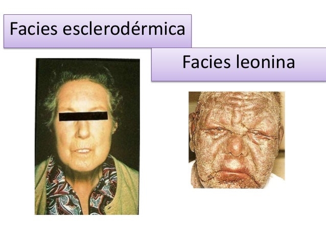 Facies Leonina