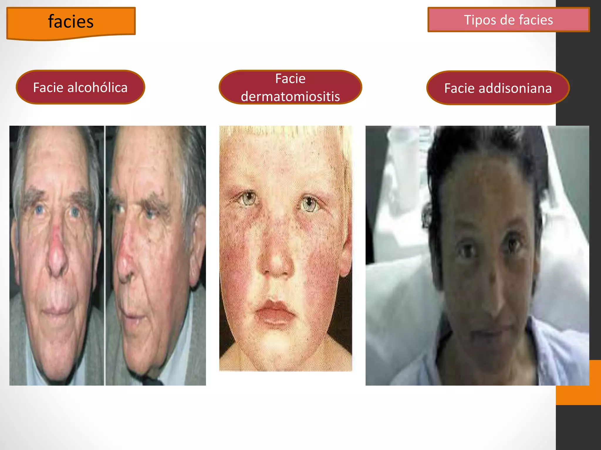 Facies, postura y marcha | PPT