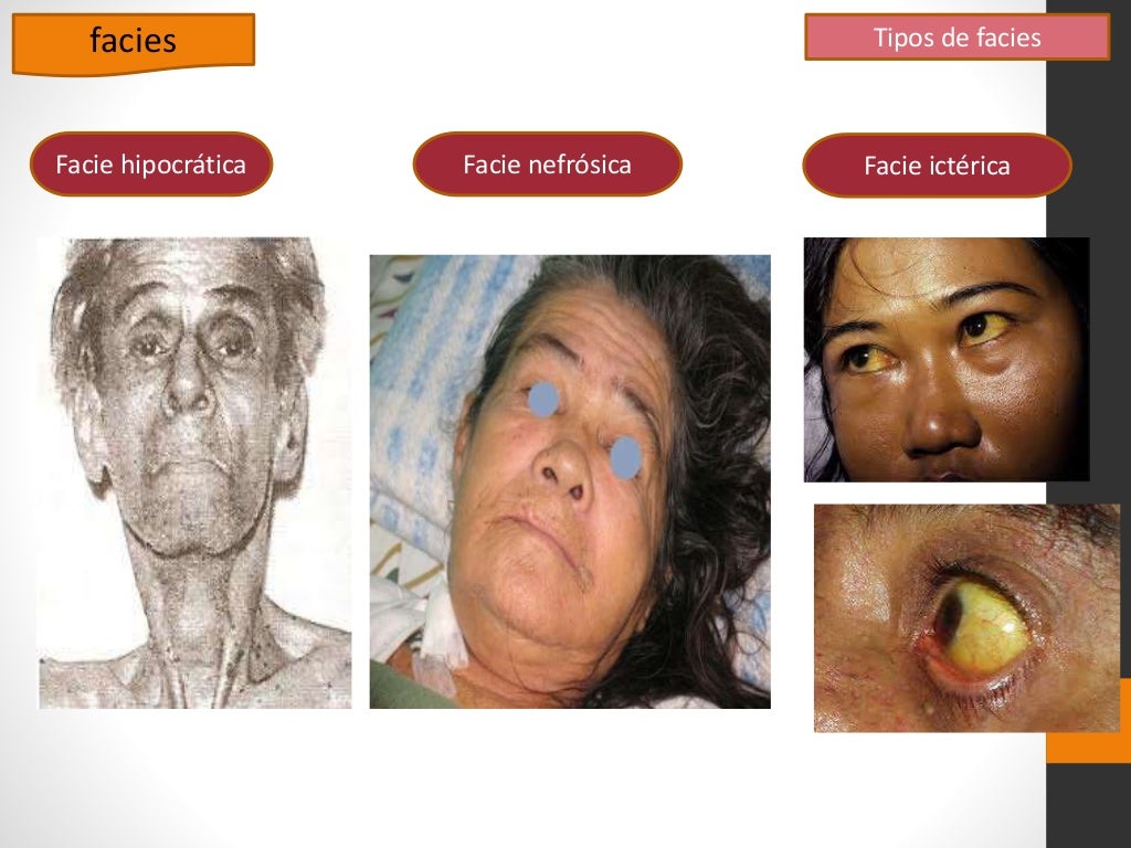 Facies, postura y marcha