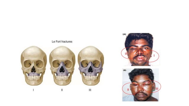 Facio maxillary injuries | PPTX | First Aid | Injuries
