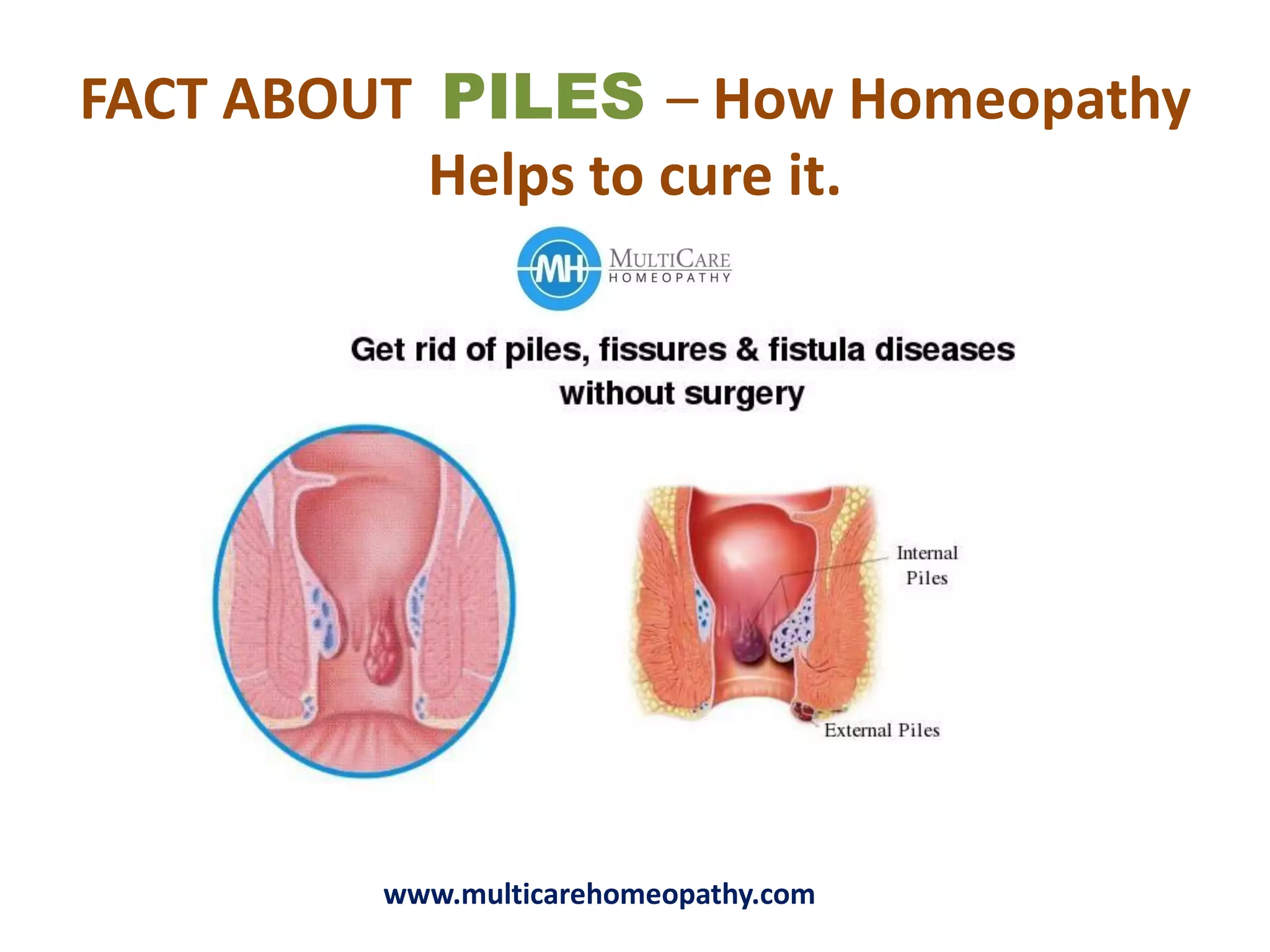 Homeopathy Helps Cure Piles Naturally | PPT