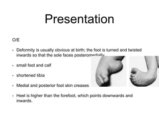 CTEV/ Clubfoot | PPTX