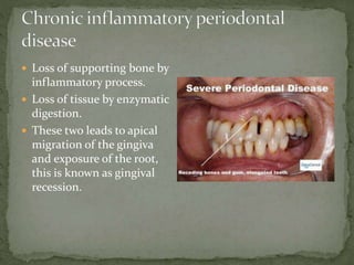 Factors affecting dentogingival junction | PPTX