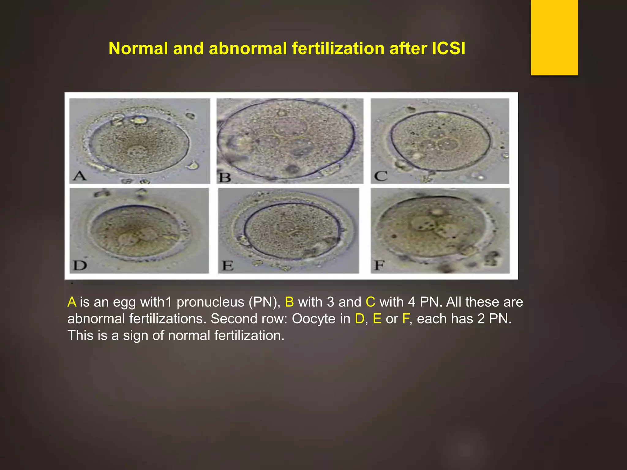 Factors affecting fertilization in icsi | PPTX