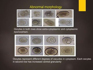 Factors affecting fertilization in icsi | PPTX