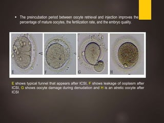 Factors affecting fertilization in icsi | PPTX