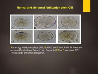 Factors affecting fertilization in icsi | PPTX