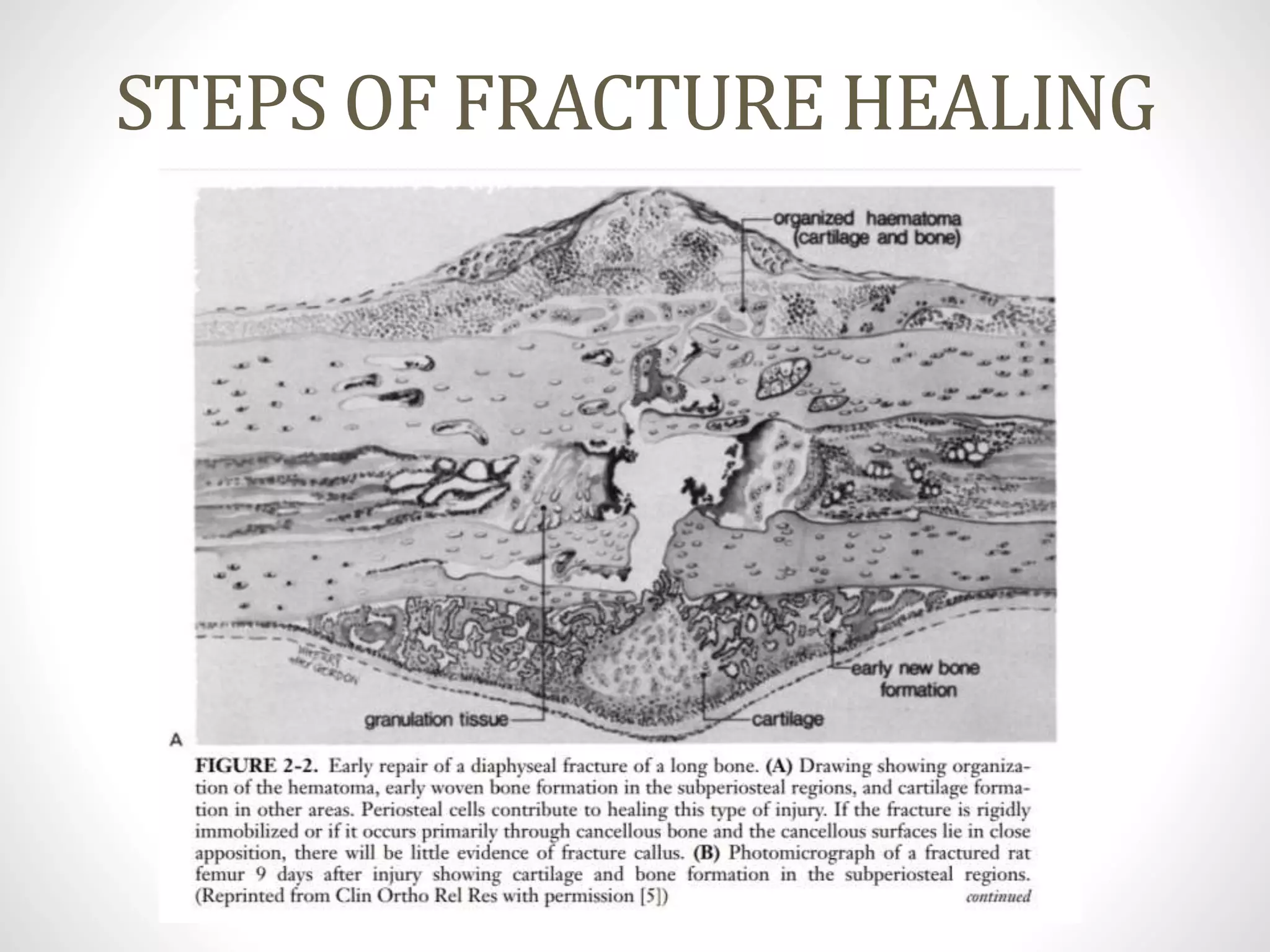 Factors affecting fracture healing | PPTX