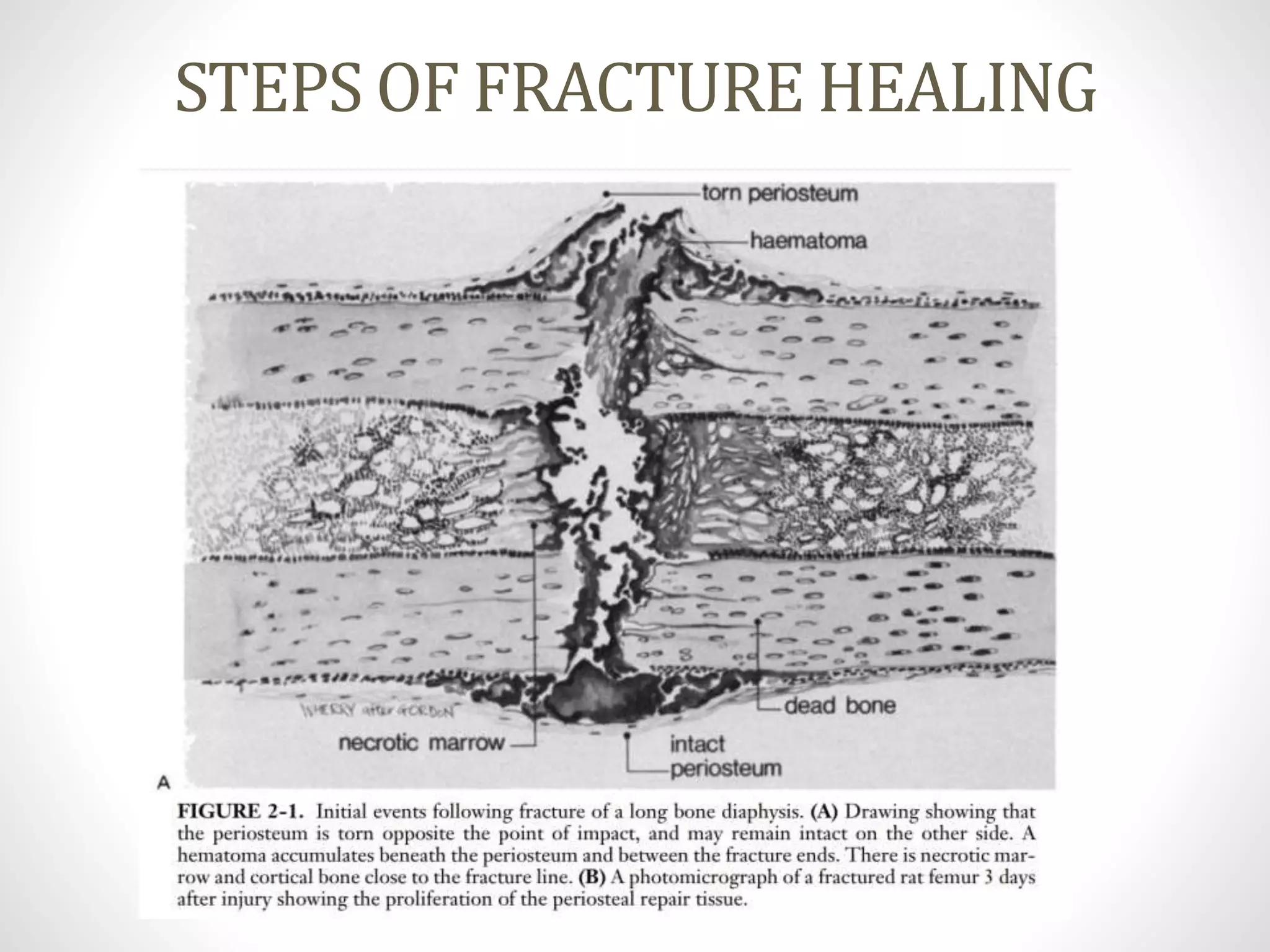 Factors affecting fracture healing | PPTX