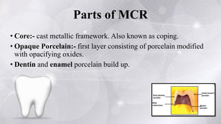 Factors affects of successful metal ceramic restorations lecture | PDF
