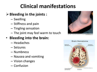 Factor v deficiency | PPTX | Blood Disorders | Diseases and Conditions